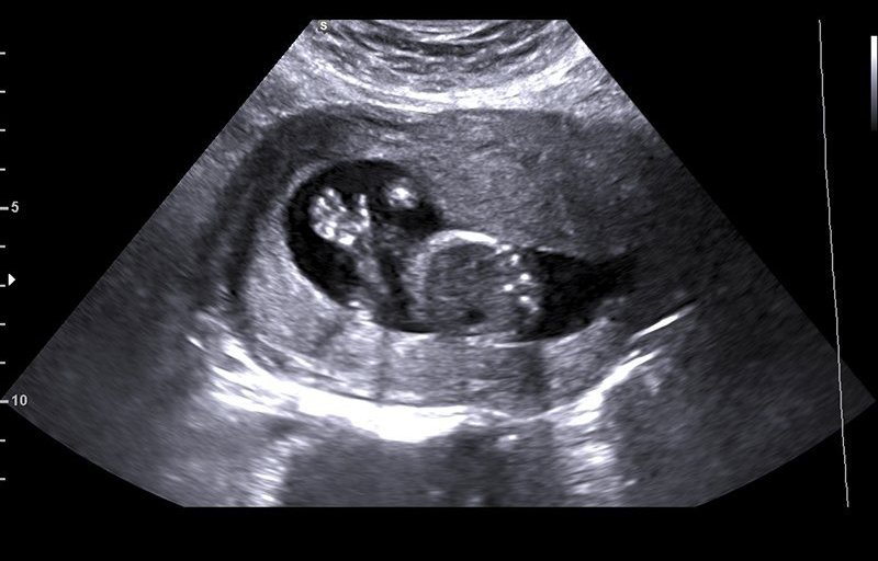 Denver Little Bellies Ultrasound 2D 3D 4D 5D HD Pregnancy Spa Denver Little Bellies Ultrasound 2D 3D 4D 5D HD Pregnancy Spa