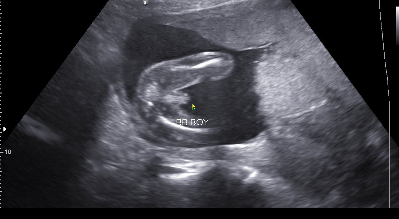 Image Gallery Little Bellies Ultrasound 2D 3D 4D 5D HD Pregnancy Spa Image Gallery Little Bellies Ultrasound 2D 3D 4D 5D HD Pregnancy Spa