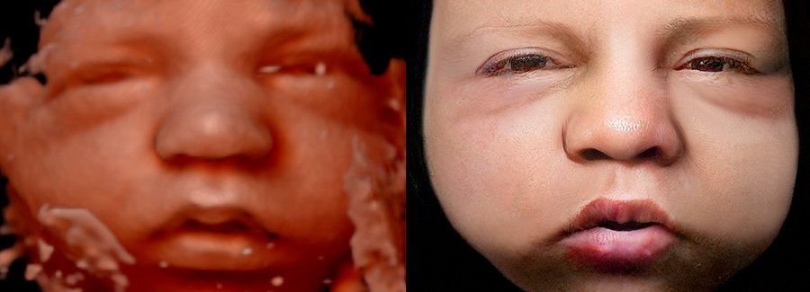 8K Realistic View Add-on - Little Bellies Ultrasound 2D/3D/4D - 5D/HD ...